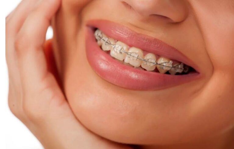 Braces & Aligners at -30°C: Prairie Winter Care Guide